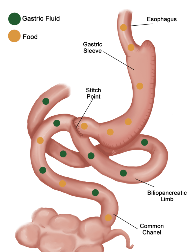 SADI-S Surgery – Dr. Jaime Ponce de León